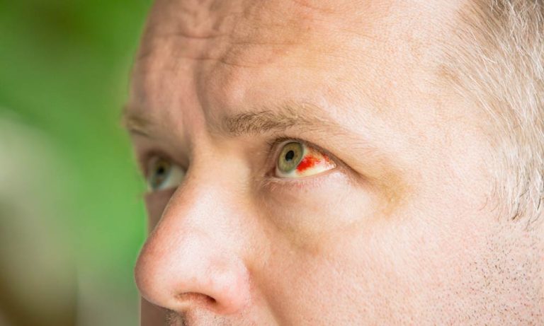 My Eye Is Bloody Red! - Ideal Eye Surgery